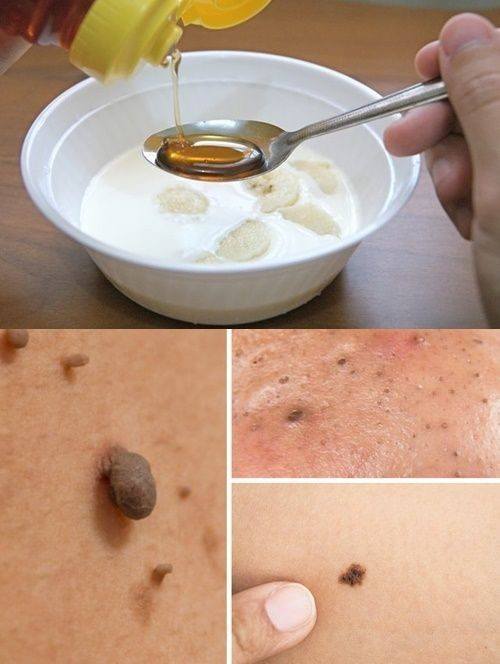 Scapă de negi, puncte negre și pete de bătrânețe în mod natural – Recipes